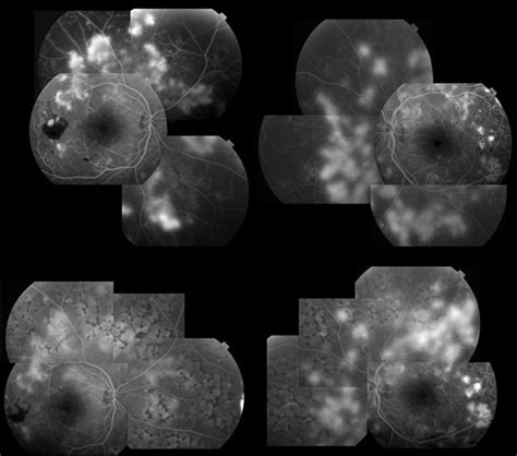 Case 3 A 51 Yr Old Female Patient With Bilateral High Risk