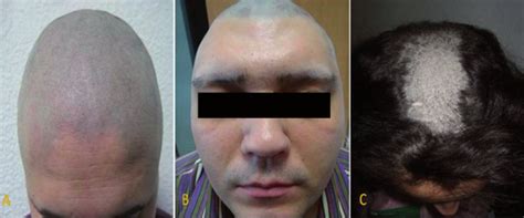 Case 1 And 2 Mild And Circumscribed Erythema On The Scalp Signs Of Download Scientific