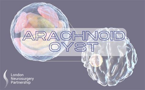 Arachnoid Cyst London Neurosurgery Spine And Neurosurgery