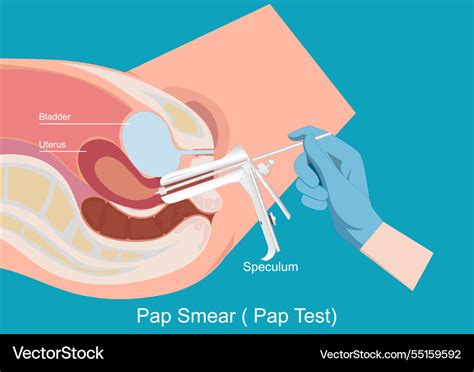 Sampling The Endocervix Using Cervical Brush Vector Image