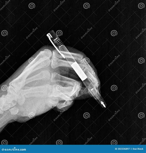 Raio x De Filme Ou Radiografia De Uma Mão Humana Um Utensílio De