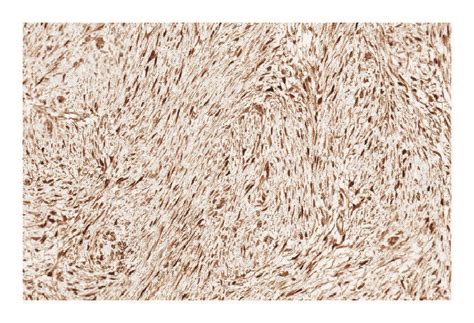 Ihc Stain For Beta Catenin ×20 Showing Characteristic Nuclear
