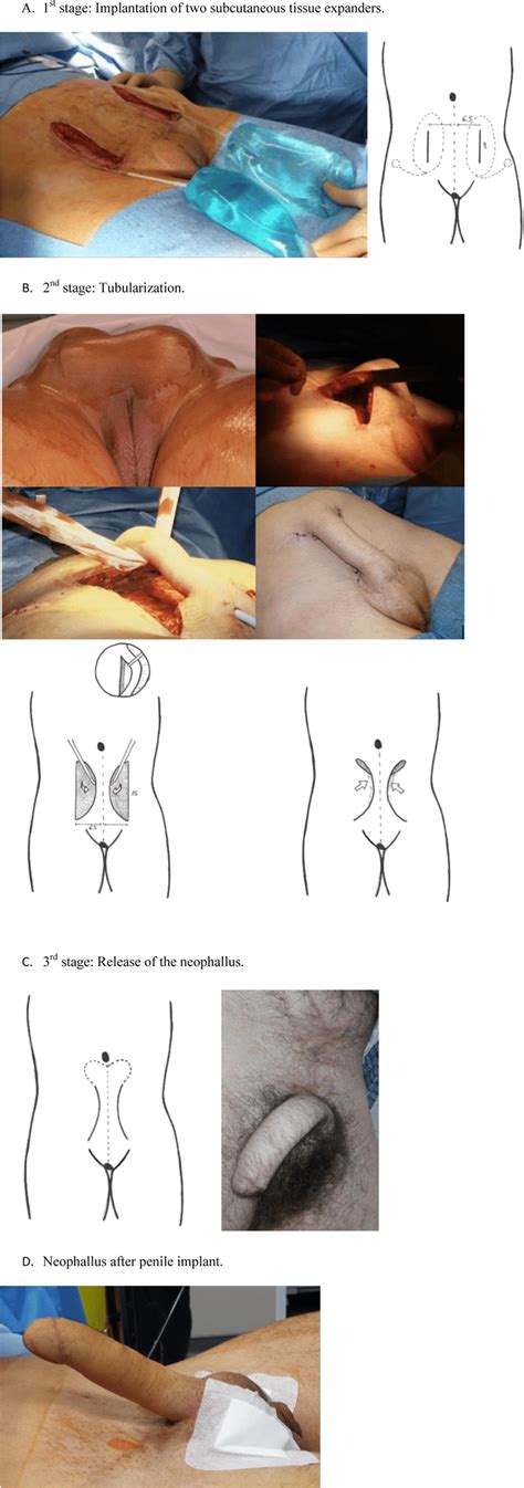 Phalloplasty Before And After Ftm Phalloplasty Before And After Ftm
