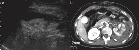A La Ceus Dimostra Una Lacerazione Parenchimale Incompleta Al Terzo