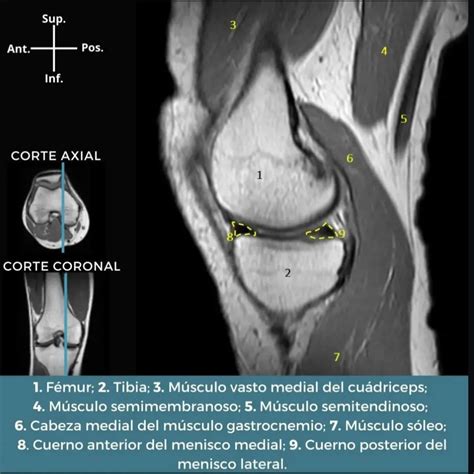 Laboratorio De Imágenes Repasamos Anatomía De La Rodilla Con Cortes