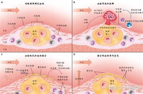 逆转动脉粥样硬化斑块的新型治疗策略 知乎