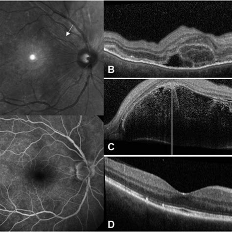 Bilateral Tuberculous Choroiditis Lesion Response To Antituberculous Download Scientific