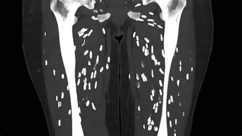 Ct Scan Reveals Parasitic Infection From Undercooked Pork Doctor Warns