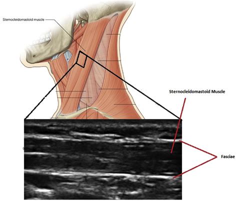 Effect Of Ischemic Compression For Cervicogenic Headache And Elastic