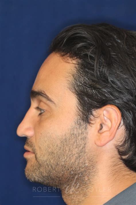 Male Rhinoplasty Rhinoplasty And Nose Surgery Beverly Hills Dr