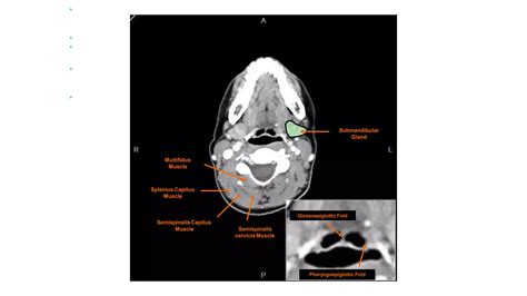 Imaging In Laryngeal Malignancy Pptx