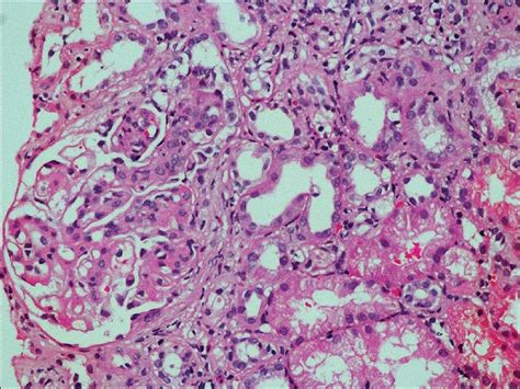 Segmental Endocapillary Proliferation H And E ×40 Download