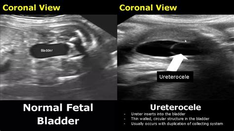 Gynecological Obstetric Ultrasound Normal Vs Abnormal