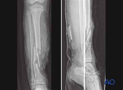 Fractured Tibia X Ray Periprosthetic Fractures Of The Tibial Shaft
