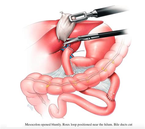 Choledocal Cyst Excision And Roux En Y Hepatico Jejunostomy Pediatric