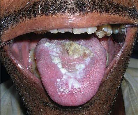 Surgical Management Of Chronic Hyperplastic Candidiasis Refractory To Systemic Antifungal