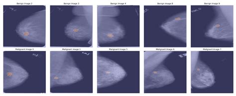 Enhanced Breast Cancer Diagnosis Using Multimodal Feature Fusion With Radiomics And Transfer
