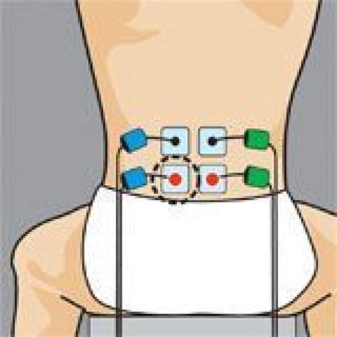 Various Placement Disgrams And Information On Electrode Placement