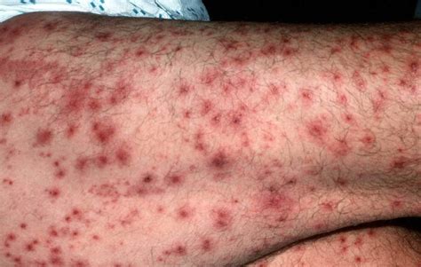 Leukocytoclastic Vasculitis Causes Symptoms Treatment