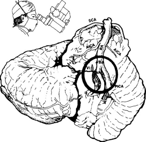 Foramen Caecum