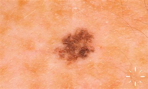 Dermacompass Lentigo Simplex Lentigo Solaris