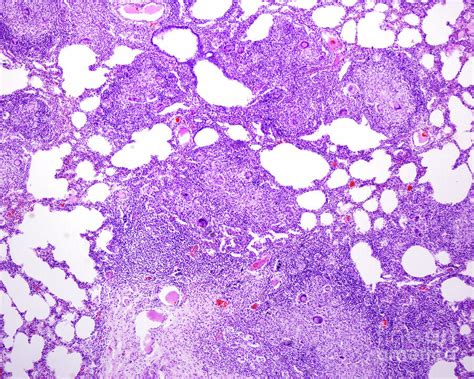 Tuberculosis 1 Photograph By Jose Calvo Science Photo Library