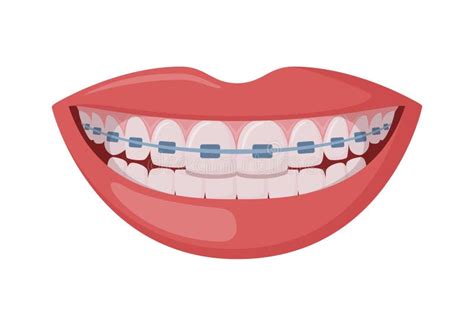 Braces Corrective Orthodontics Smiling Female Mouth With Healthy Teeth