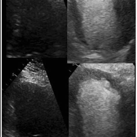 Contrast Echo Imaging Showing Improvement In Endocardial Definition To