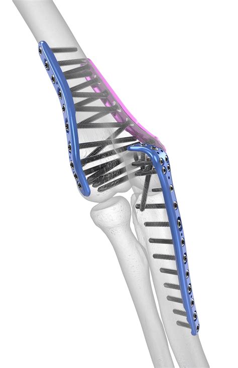 Elbow Plating System Plates Acumed