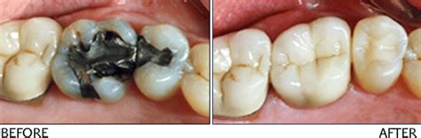 How Much Is A Dental Bridge In Ontario Gold Dental Bridge