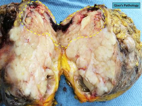 Qiaos Pathology Phyllodes Tumor Of The Breast With Sarcomatous
