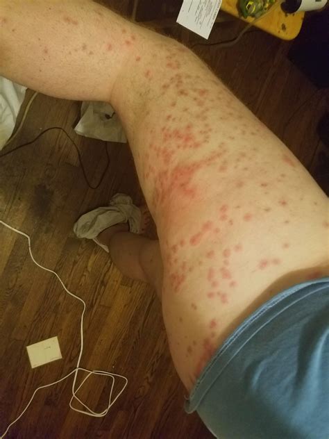 Bed Bugs Suck Updated Album On Imgur