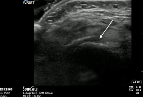 Us Probe Pocus For The Diagnosis Of Acute Pediatric Distal Radius