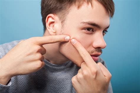 위생 및 피부 문제 얼굴에 여드름을 압박 하는 젊은 갈색 머리 남자의 초상화입니다 파란색 배경에 격리 20 29세에 대한 스톡