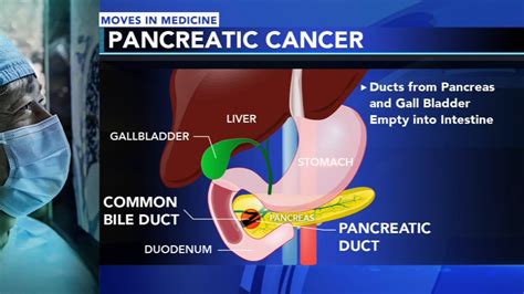 New Study Looks At Environment And Pancreatic Cancer Around The