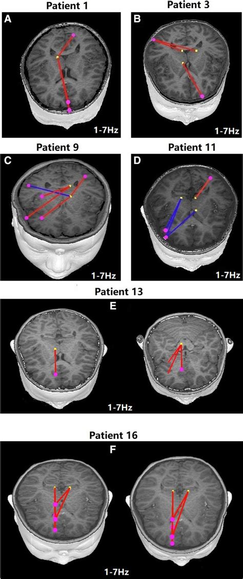 The Frontocorticooccipital Functional Connectivity Fc A Download Scientific Diagram
