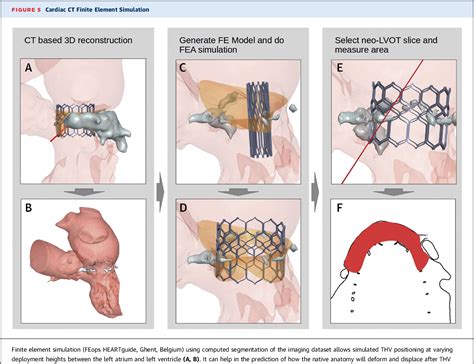 Figure 5 From Management Of Patients With Severe Mitral Annular Calcification Jacc State Of The
