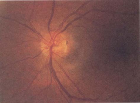 Left Eye Showing Flat Neovascularisation At The Optic Disc Download
