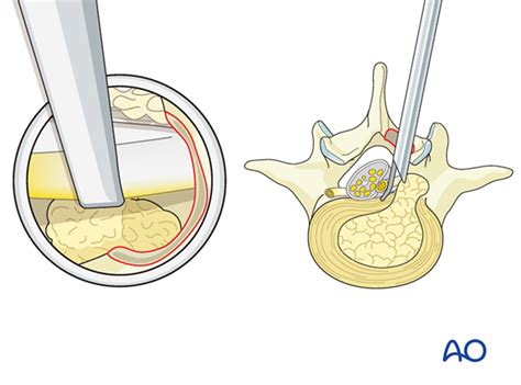 Interlaminar Endoscopic Lumbar Discectomy Ield For Lumbar Disc