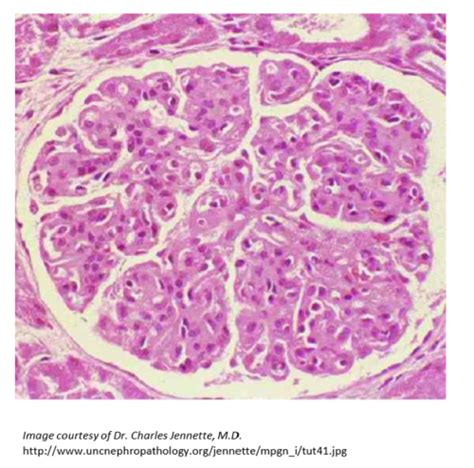 Pathology Of Glomerular Diseases Flashcards Quizlet