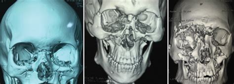 Nasoorbitoethmoid Fractures In A Tertiary Care Hospital Of Eastern