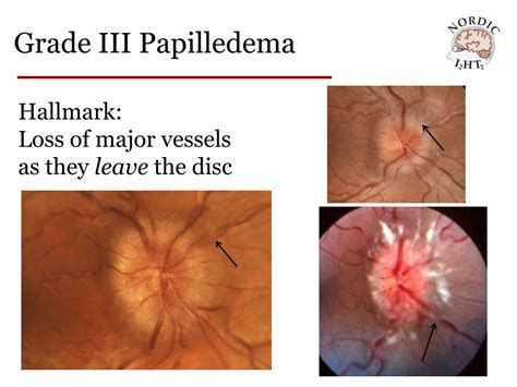 Papilledema Grading