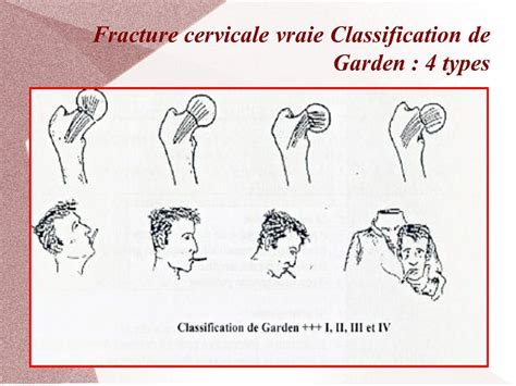 Fracture Du Col Et De La Tete Du Femur Ppt Video Online Télécharger