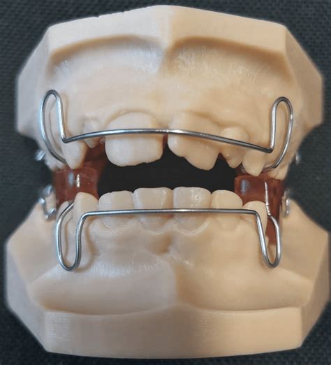 Twin Block Laboratoire Dentaire Orthodesign Sarl