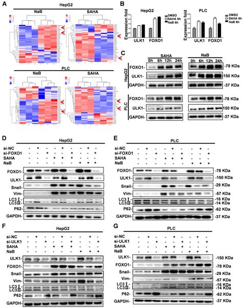 Role Of Foxo1 And Ulk1 In Regulating Autophagy And Emt In Hepatoma