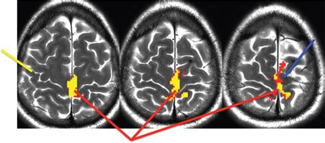 Language Mapping Using Fmri And Direct Cortical Stimulation Topics In Magnetic Resonance