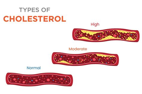 Ldl Hdl And Triglycerides And Their Effects On Health 52364896 Vector Art At Vecteezy