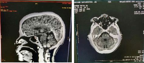 Non Enhanced Head CT Scan Download Scientific Diagram