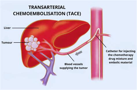 Liver Cancer Treatment With Transarterial Chemoembolisation Tace For A 90 Year Old Man Fv