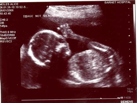 From Bump To Baby Weeks Pregnant